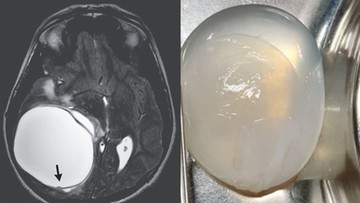 Indie: Nastolatek zakaził się bąblowicą. Lekarze wycięli mu torbiel z ...